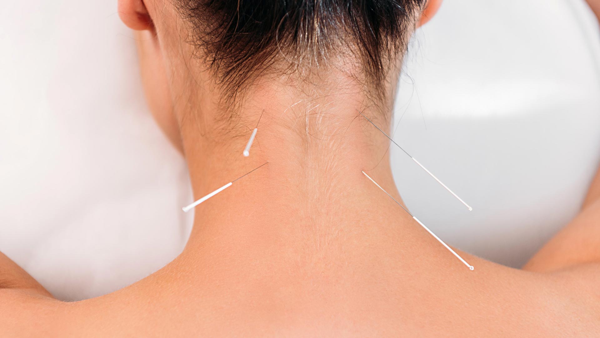 Can acupuncture help with cervical radiculopathy? - Southern California ...